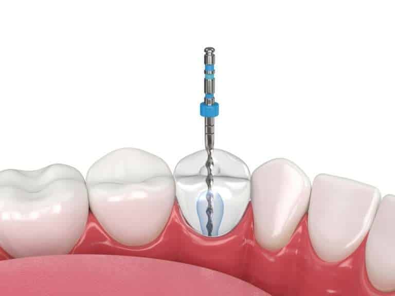 Root Canal Cost Toronto – Westwood Gardens Dental Clinic